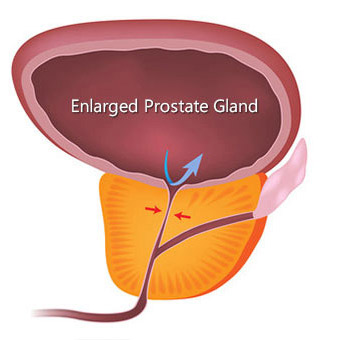 Benign Prostatic Hyperplasia (BPH) – Enlarged Prostate - Top Urologist NYC
